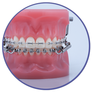Orthodontic Appliances | Sycamore Orthodontics & Pediatric Dentistry