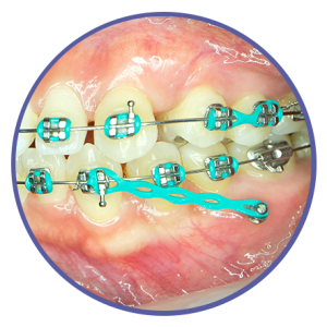 Orthodontic Appliances | Sycamore Orthodontics & Pediatric Dentistry